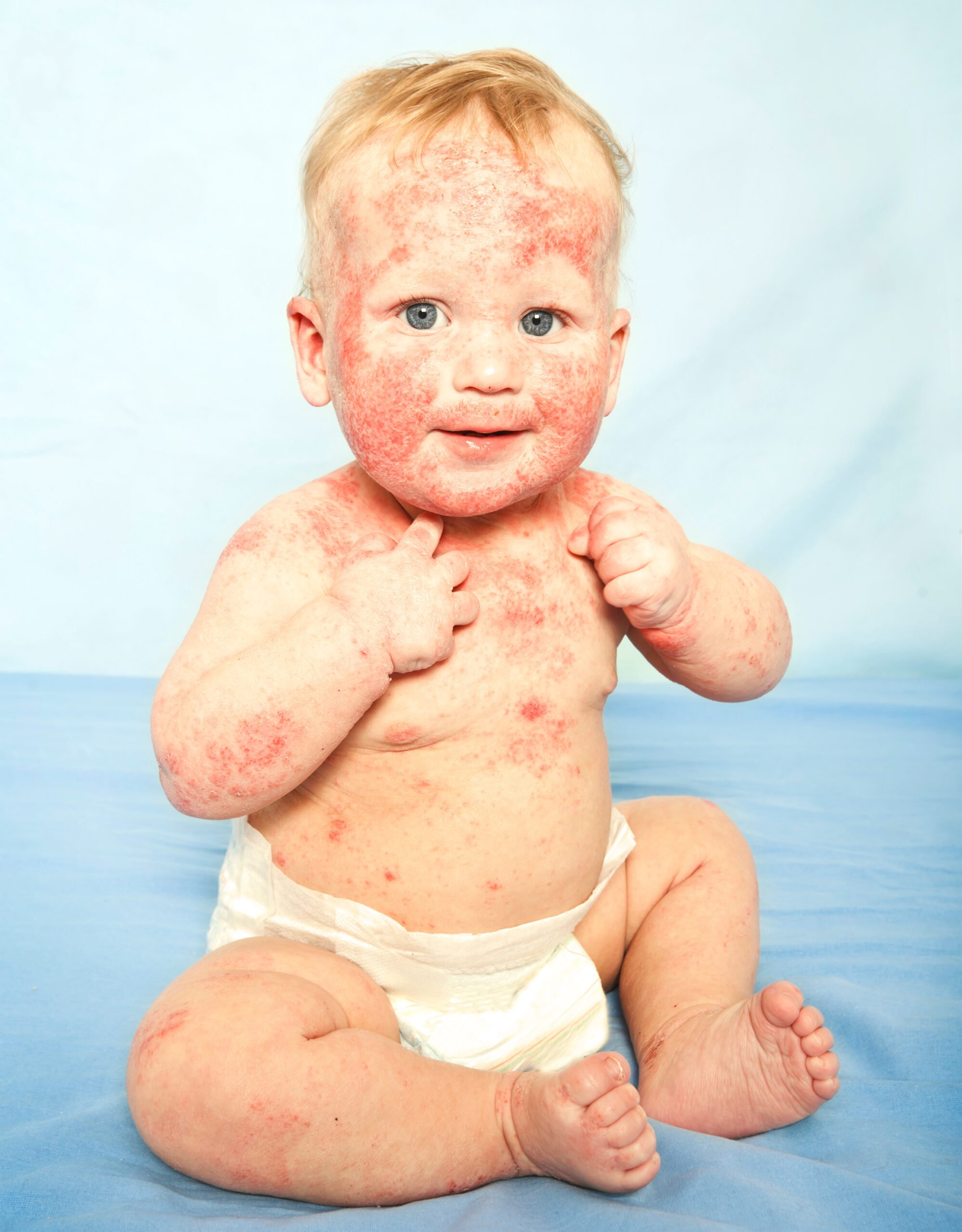 Atopiskt eksem - Astma- och Allergiföreningen Atopikerna